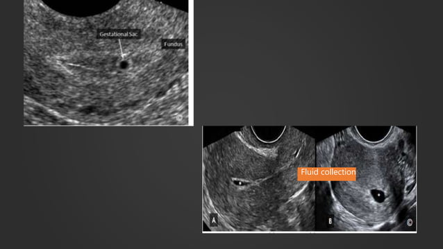 Usg in first trimester | PPTX