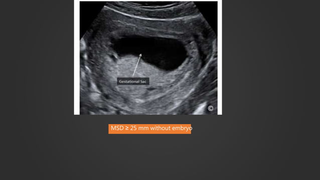 Usg in first trimester | PPTX