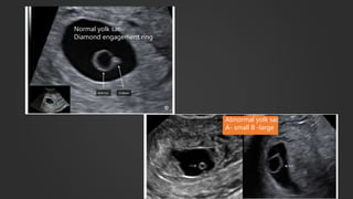 Usg in first trimester | PPTX