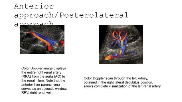 Ultrasound of renal hyperTension and Doppler findings | PPT