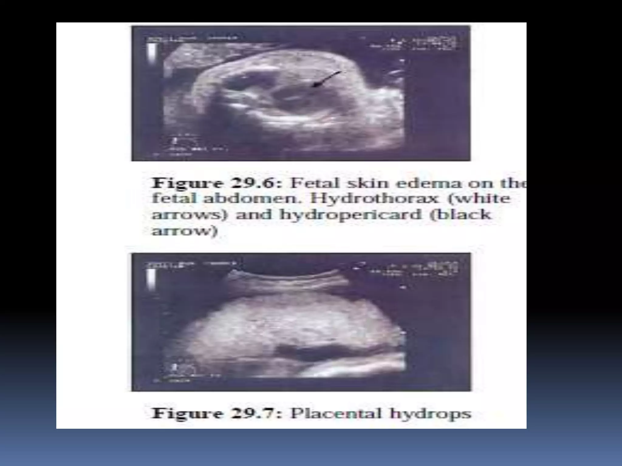 Usg in third trimester | PPTX