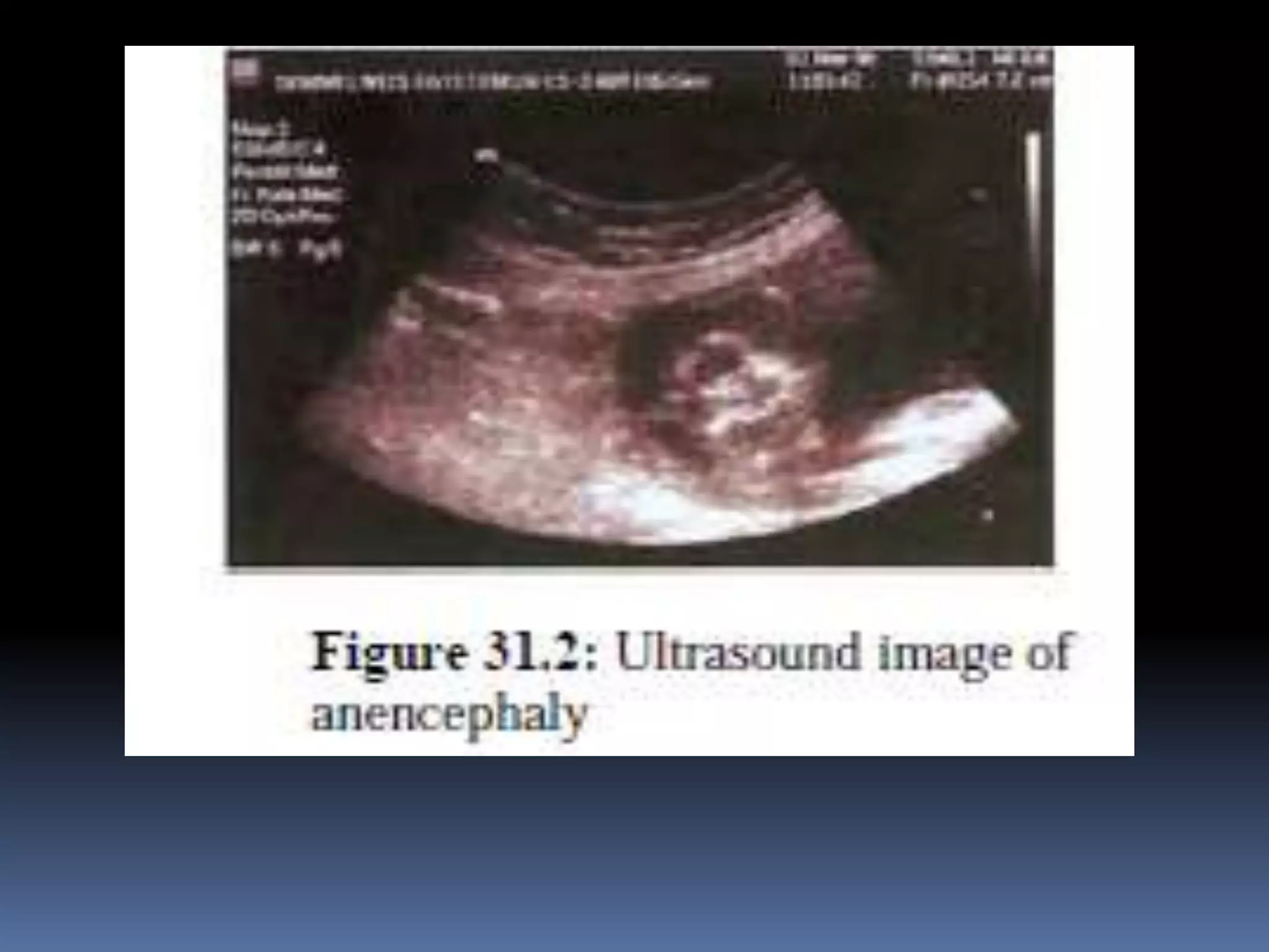 Usg in third trimester | PPTX