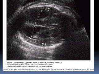 Usg in third trimester | PPTX
