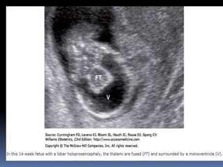 Usg in third trimester | PPTX