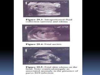 Usg in third trimester | PPTX