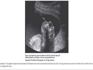 Usg in third trimester | PPTX