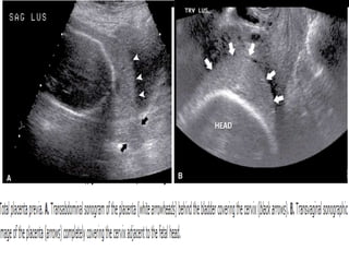Usg in third trimester | PPTX