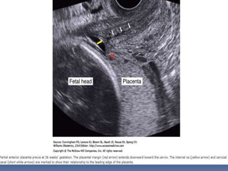 Usg in third trimester | PPTX