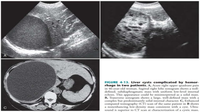 Ultrasonography of liver | PPTX | Medical Health