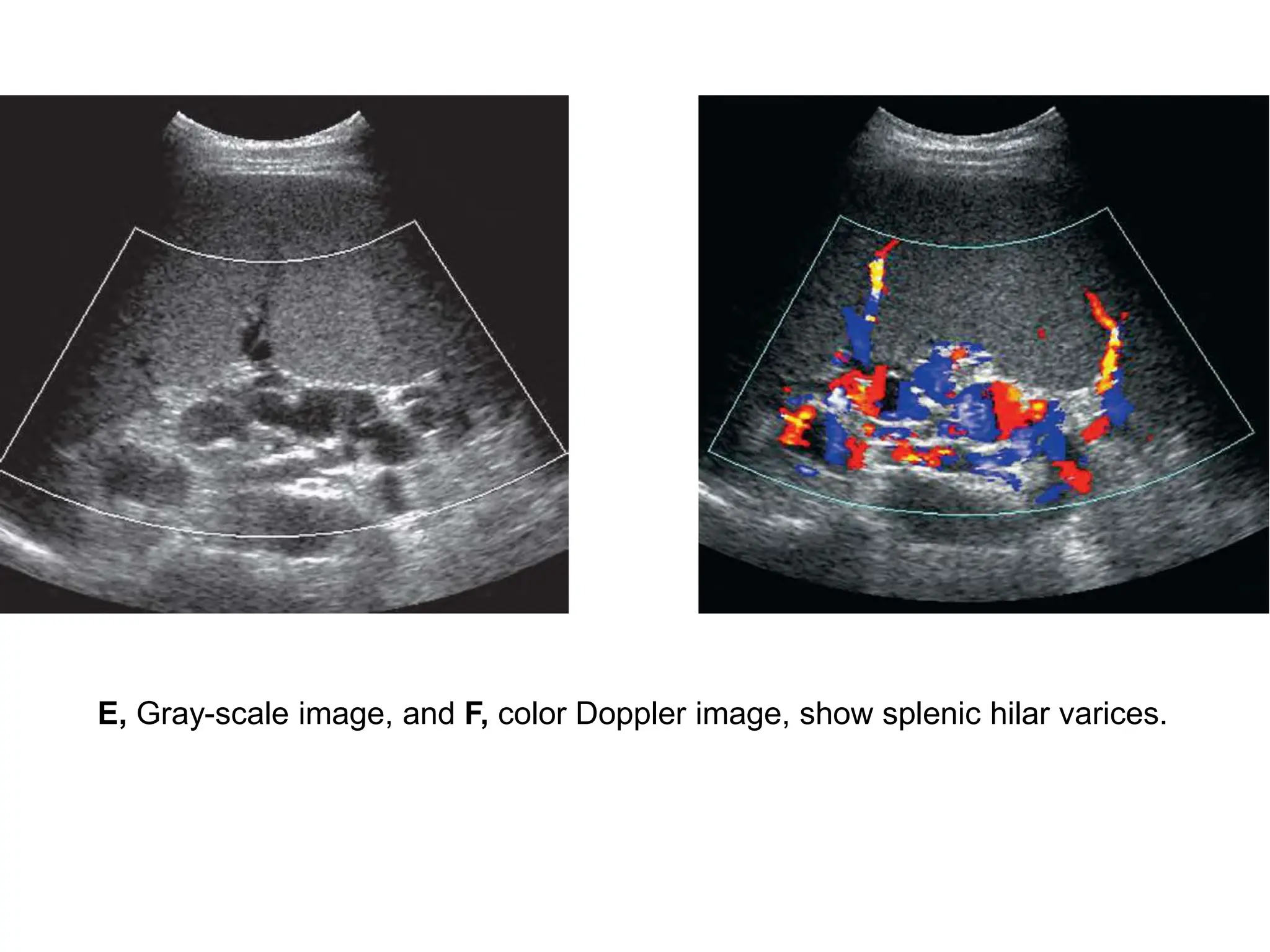 usglivercirrhosis-190918135350.pdf important | PPT