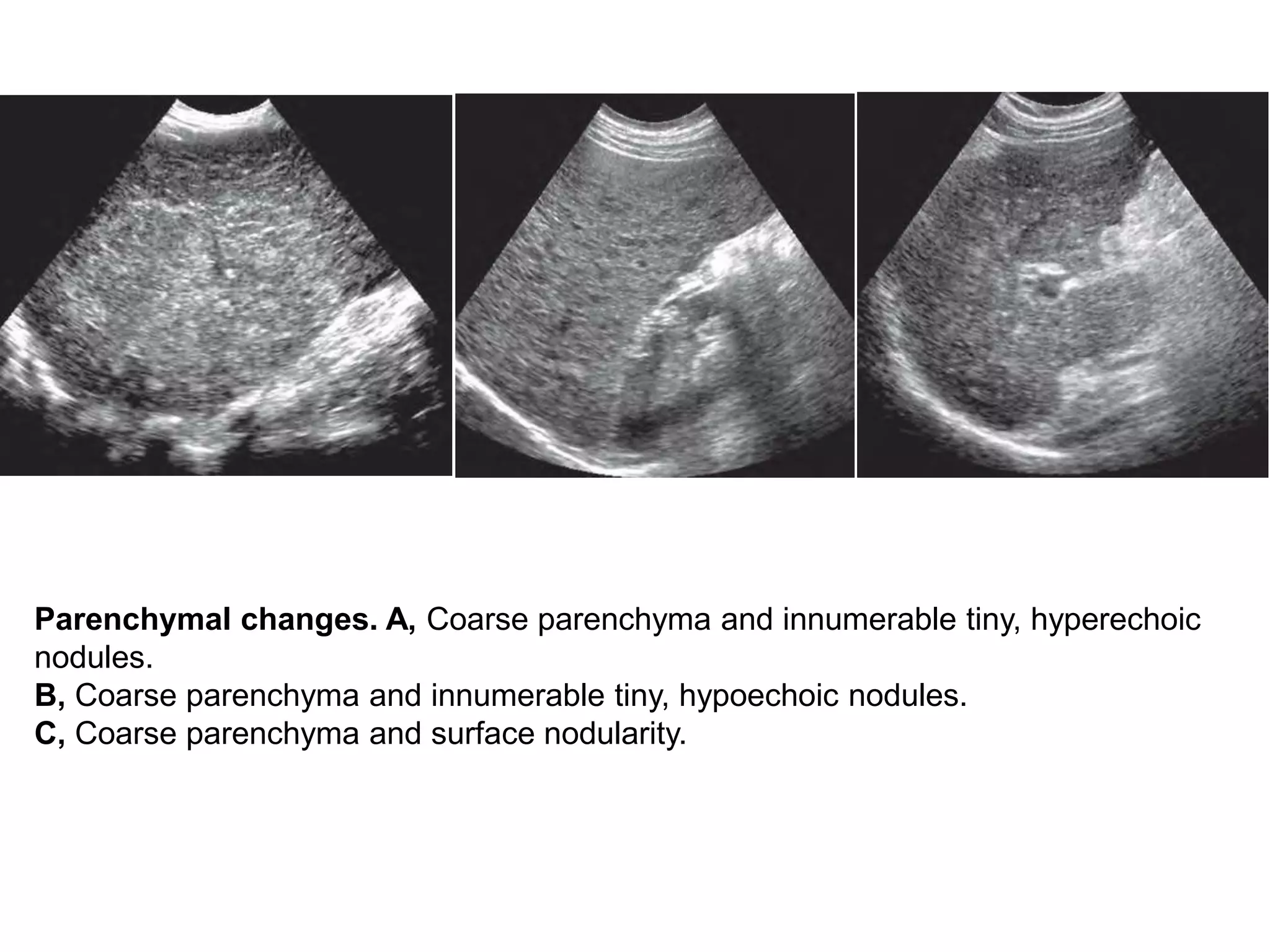 Liver cirrhosis USG | PPTX