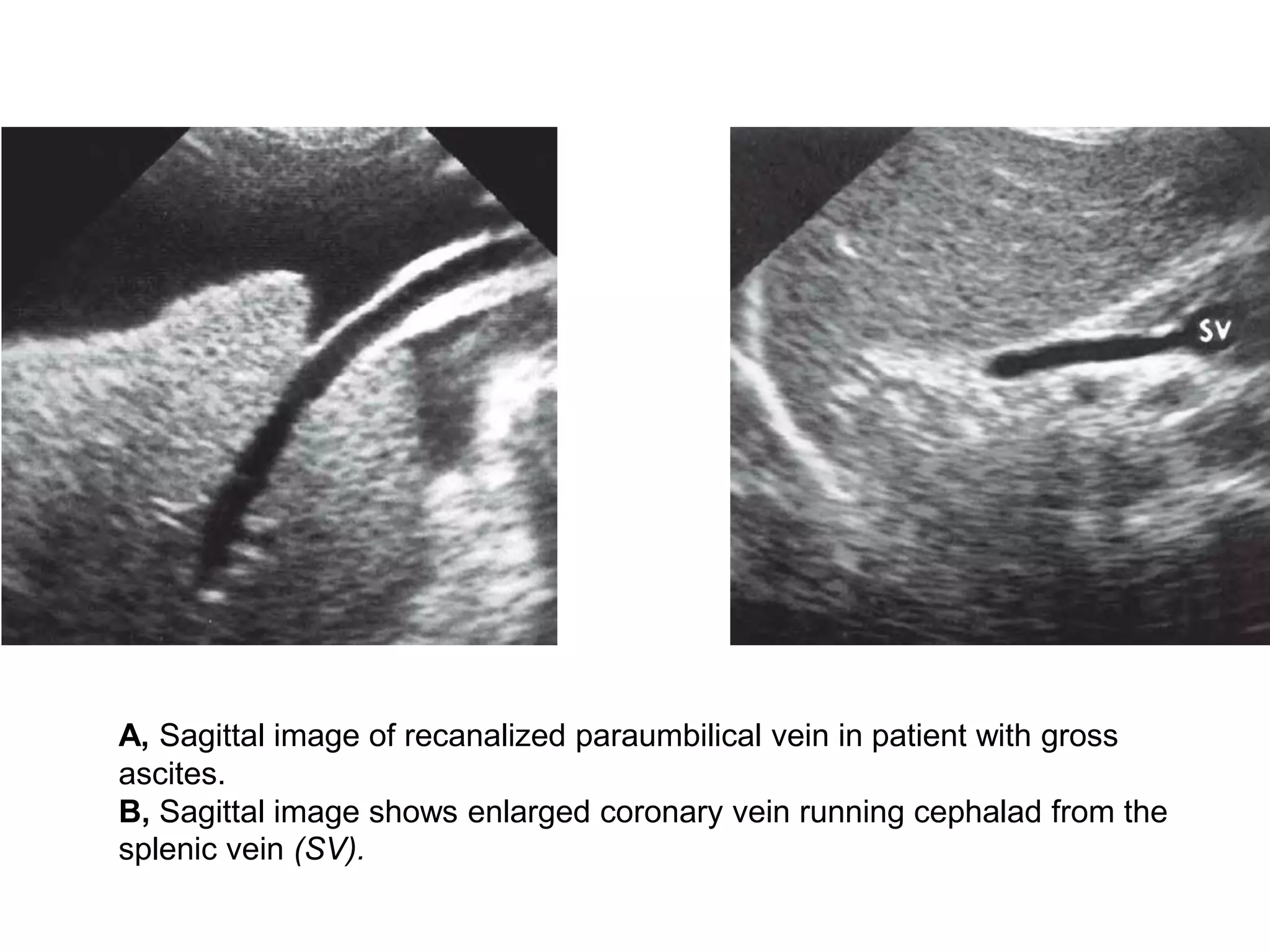 Liver cirrhosis USG | PPTX