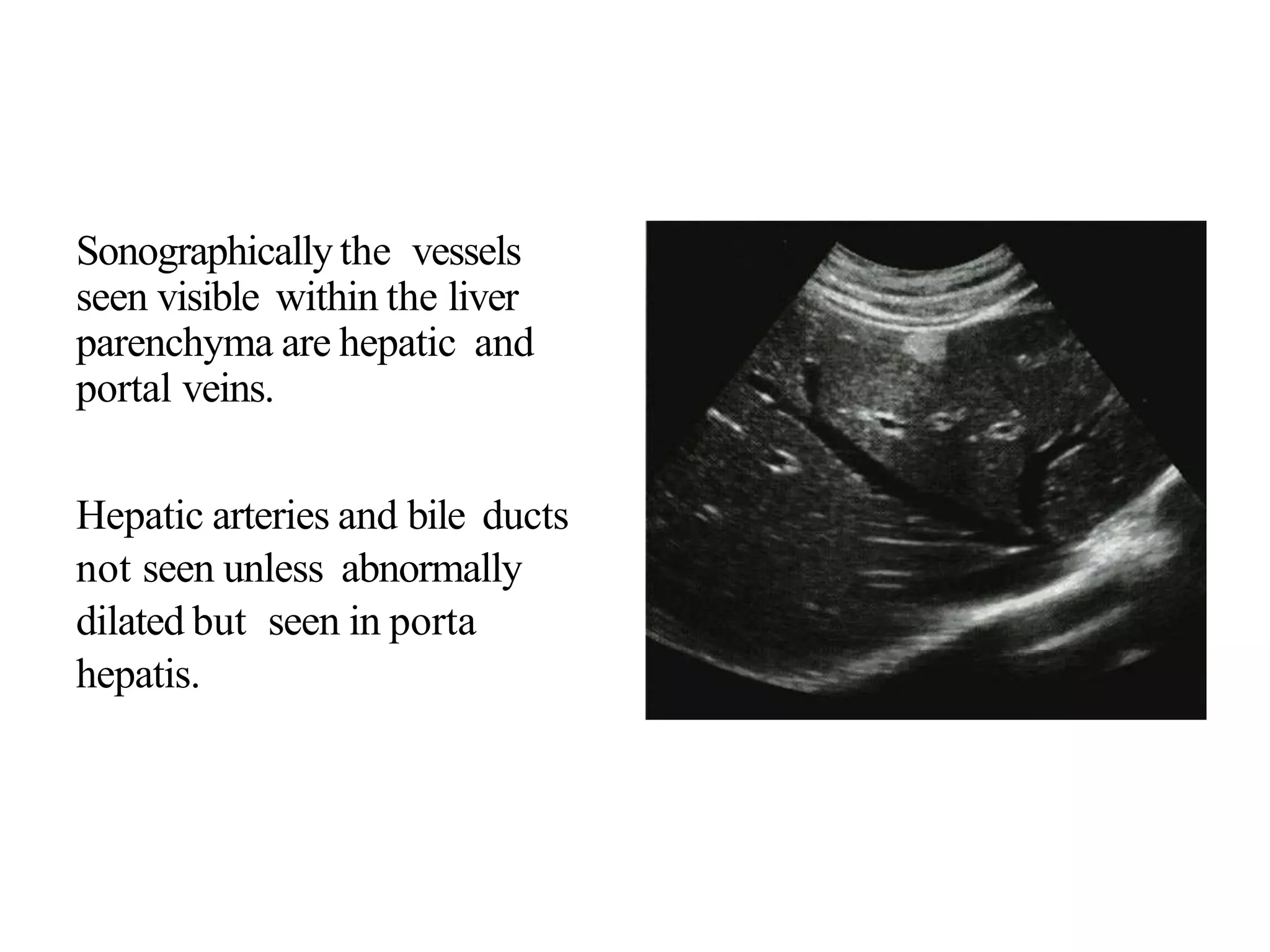 Liver cirrhosis USG | PPTX