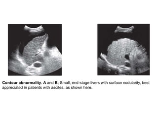 Liver cirrhosis USG | PPTX