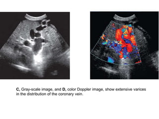 Liver cirrhosis USG | PPTX