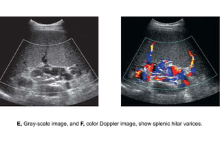 Liver cirrhosis USG | PPTX