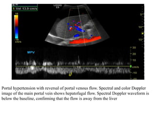 Liver cirrhosis USG | PPTX