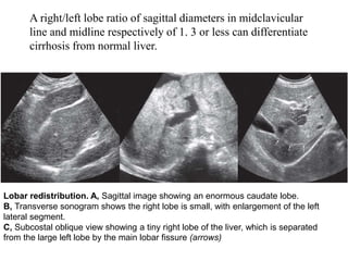 Liver Fibrosis Ultrasound