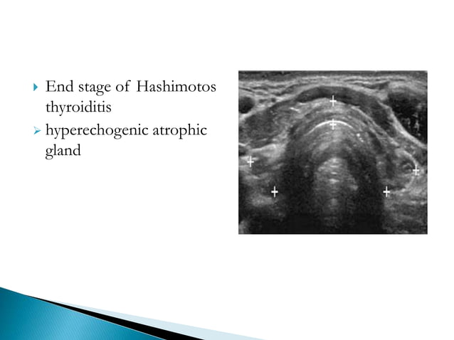 Usg neck | PPTX | Thyroid Disorders | Endocrine and Metabolic Diseases