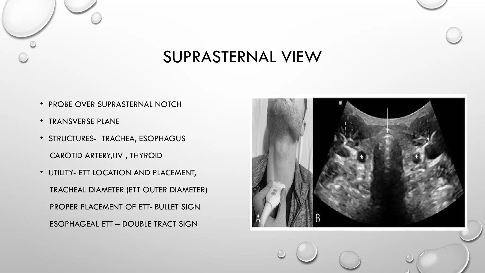 usg of airway prediction and assessment of difficult airway - an ...