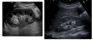 USG OF KIDNEYS.pptx