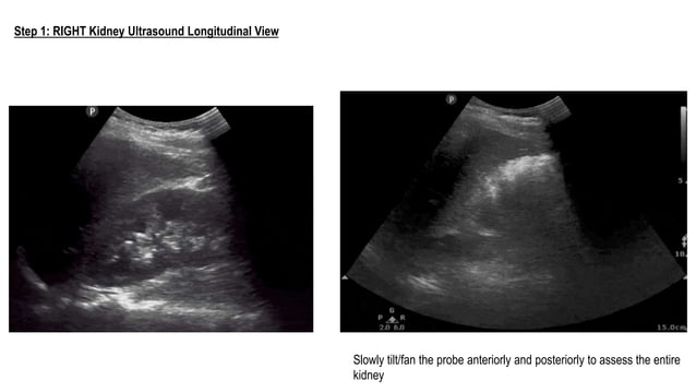 USG OF KIDNEYS.pptx