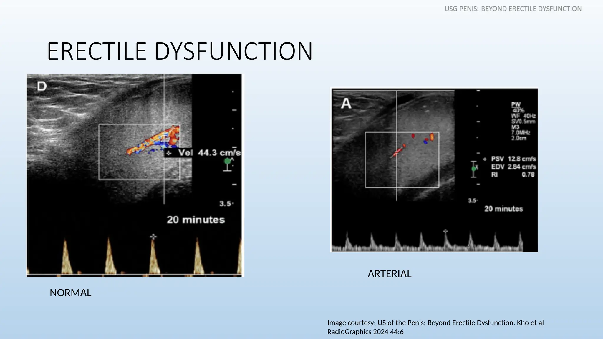 USG PENIS a review of anatomy and erectile dysfunction | PPT