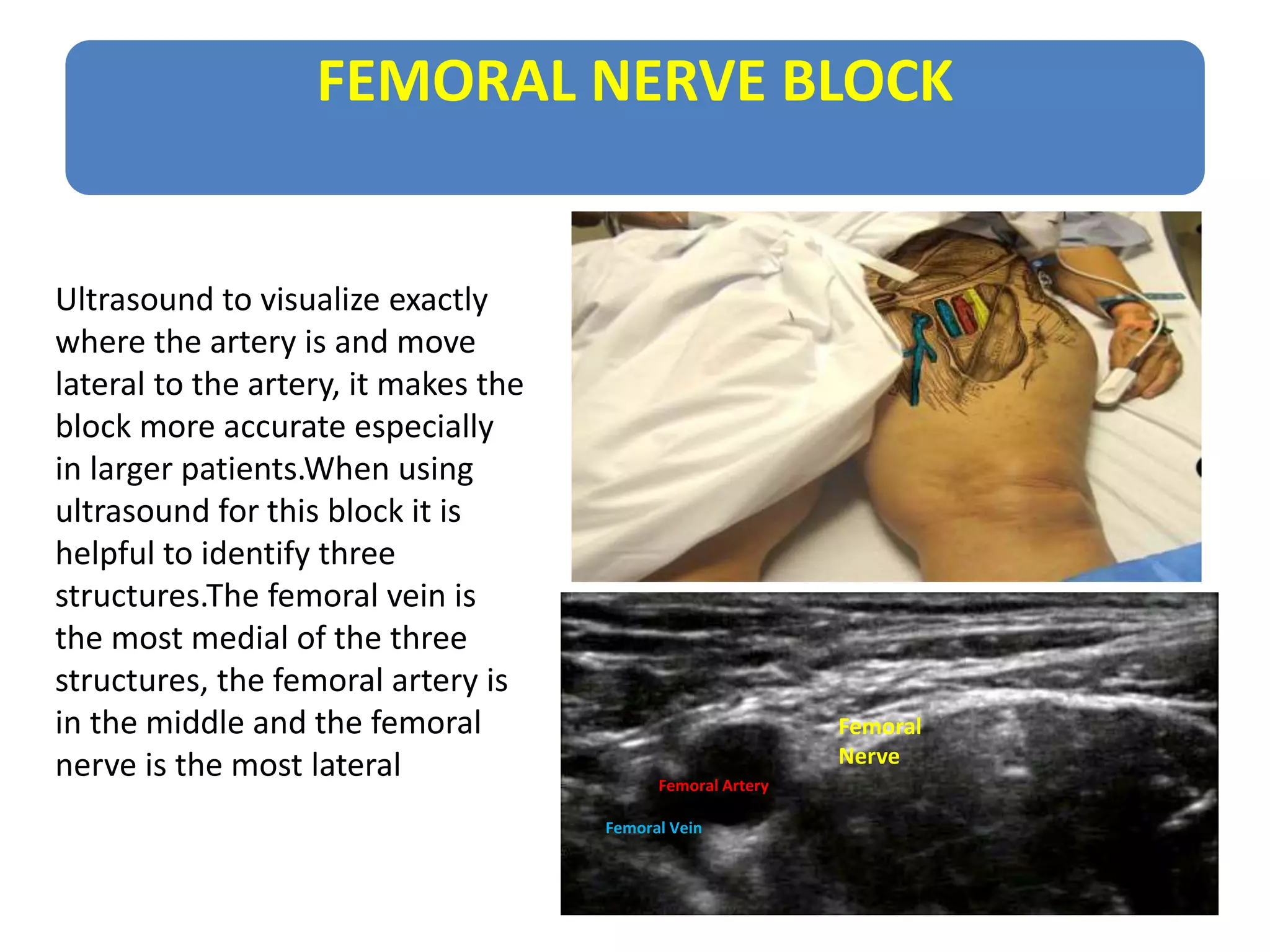 Usg r nerve block | PPTX