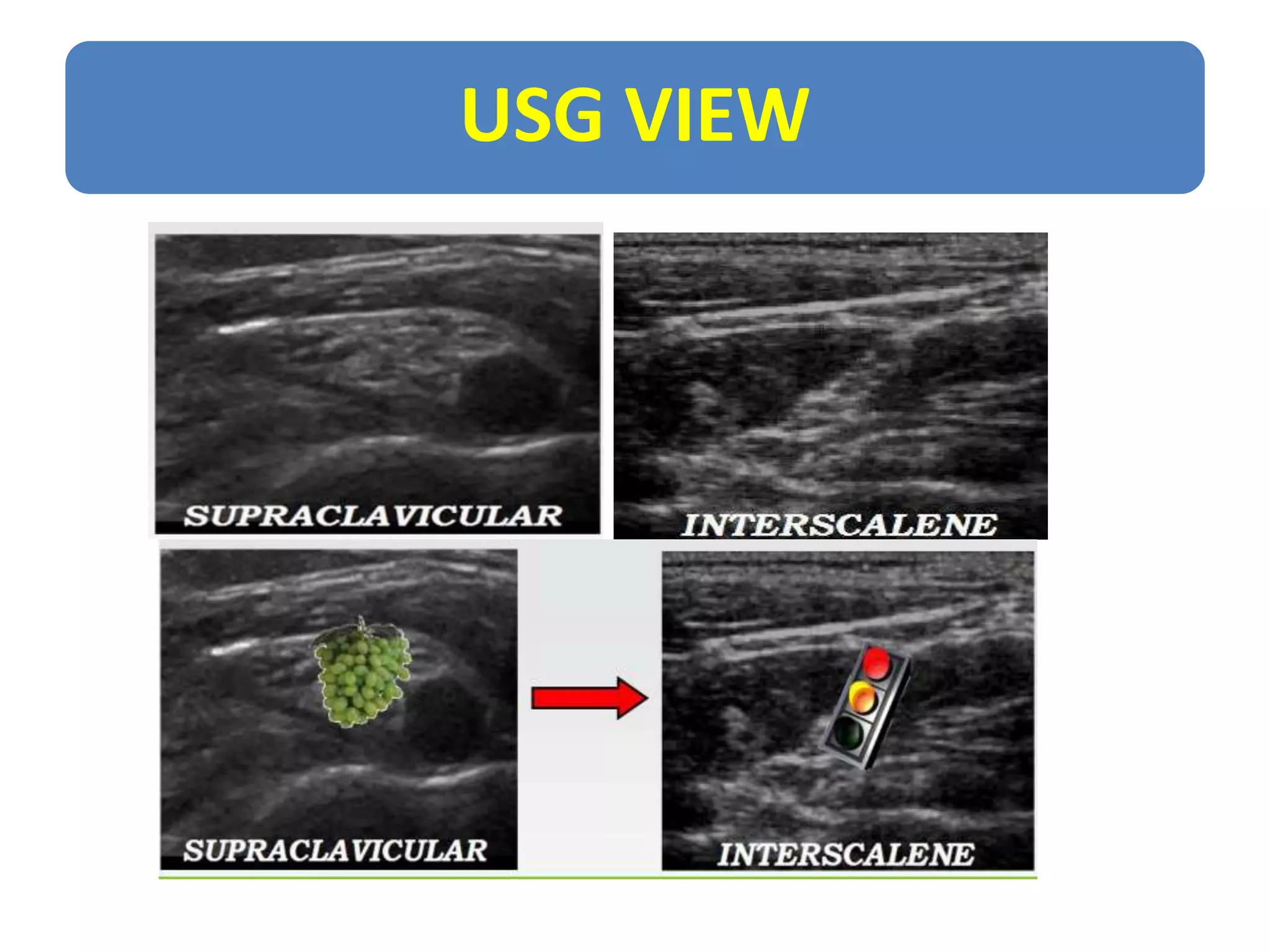 Usg r nerve block | PPTX