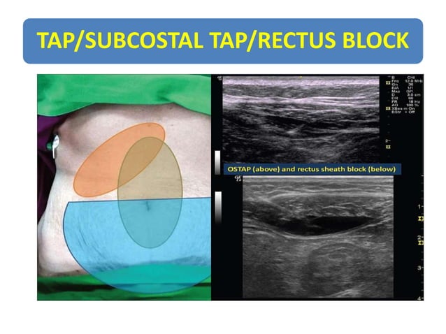 Usg r nerve block | PPTX | Death, Injury, or Military Conflict ...