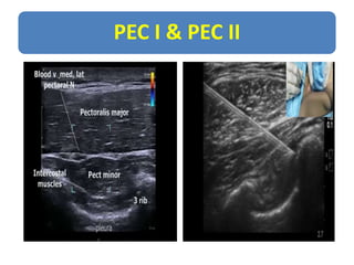 Usg r nerve block | PPTX