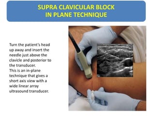 Usg r nerve block | PPTX