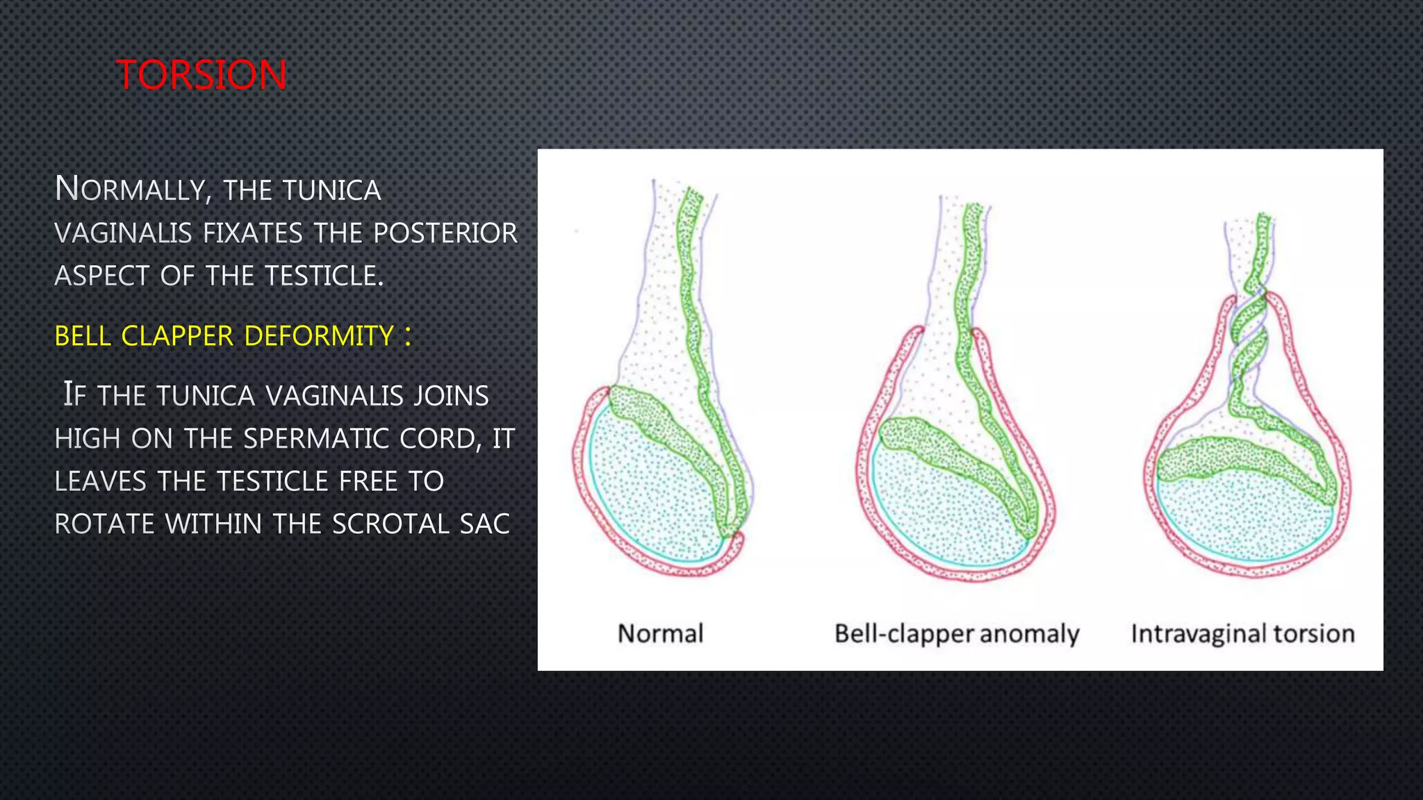 ULTRASOUND SCROTUM | PPTX