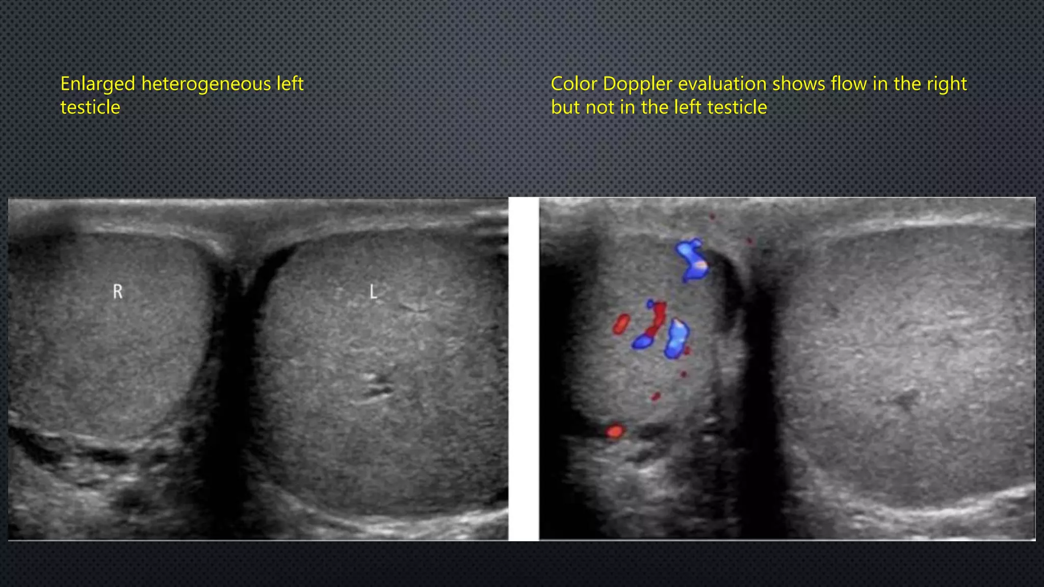 Ultrasound Scrotum Ppt