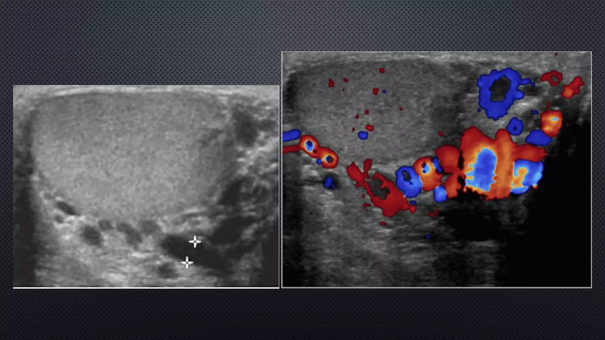 ULTRASOUND SCROTUM | PPTX