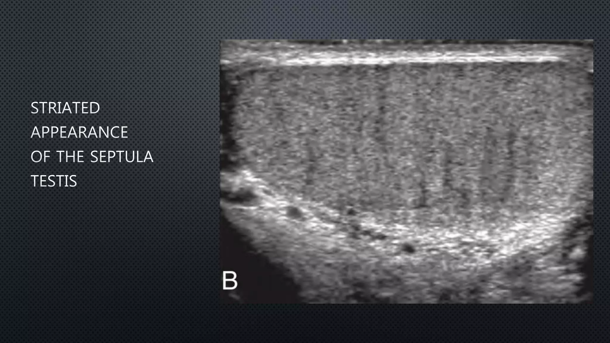 Ultrasound Scrotum Ppt