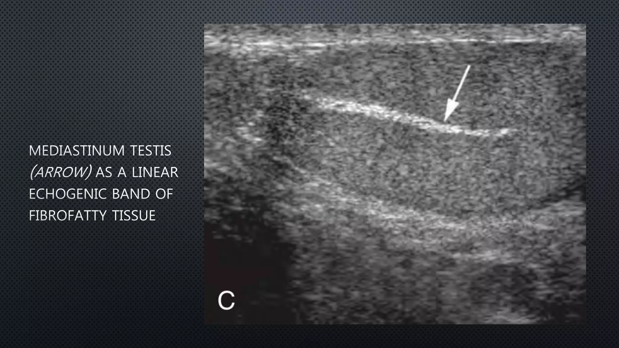 Ultrasound Scrotum Ppt