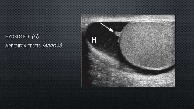 Ultrasound Scrotum Ppt