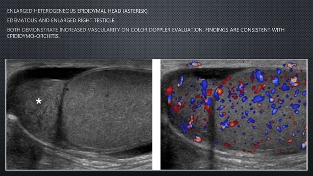 Ultrasound Scrotum Ppt