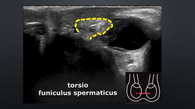 Ultrasound Scrotum Ppt