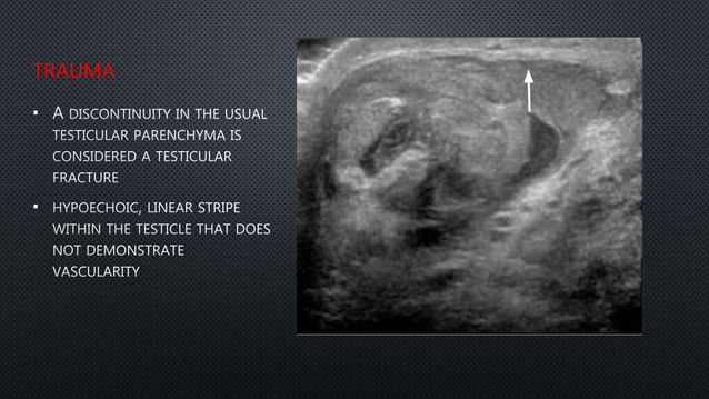 Ultrasound Scrotum Ppt