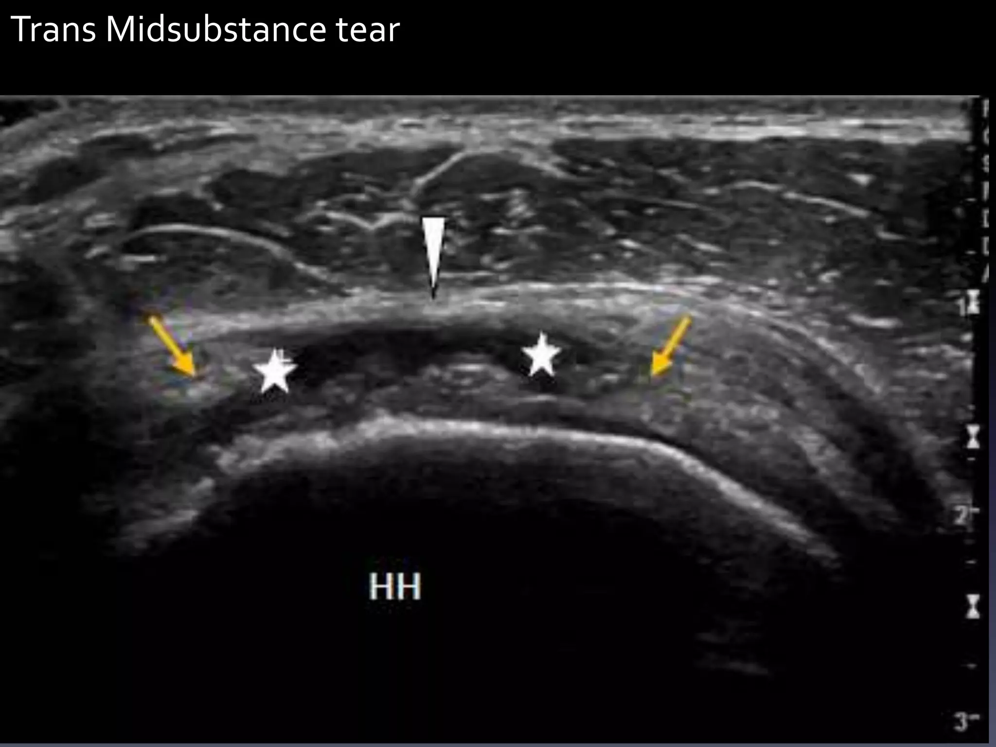Ultrasound shoulder and knee joints | PPTX