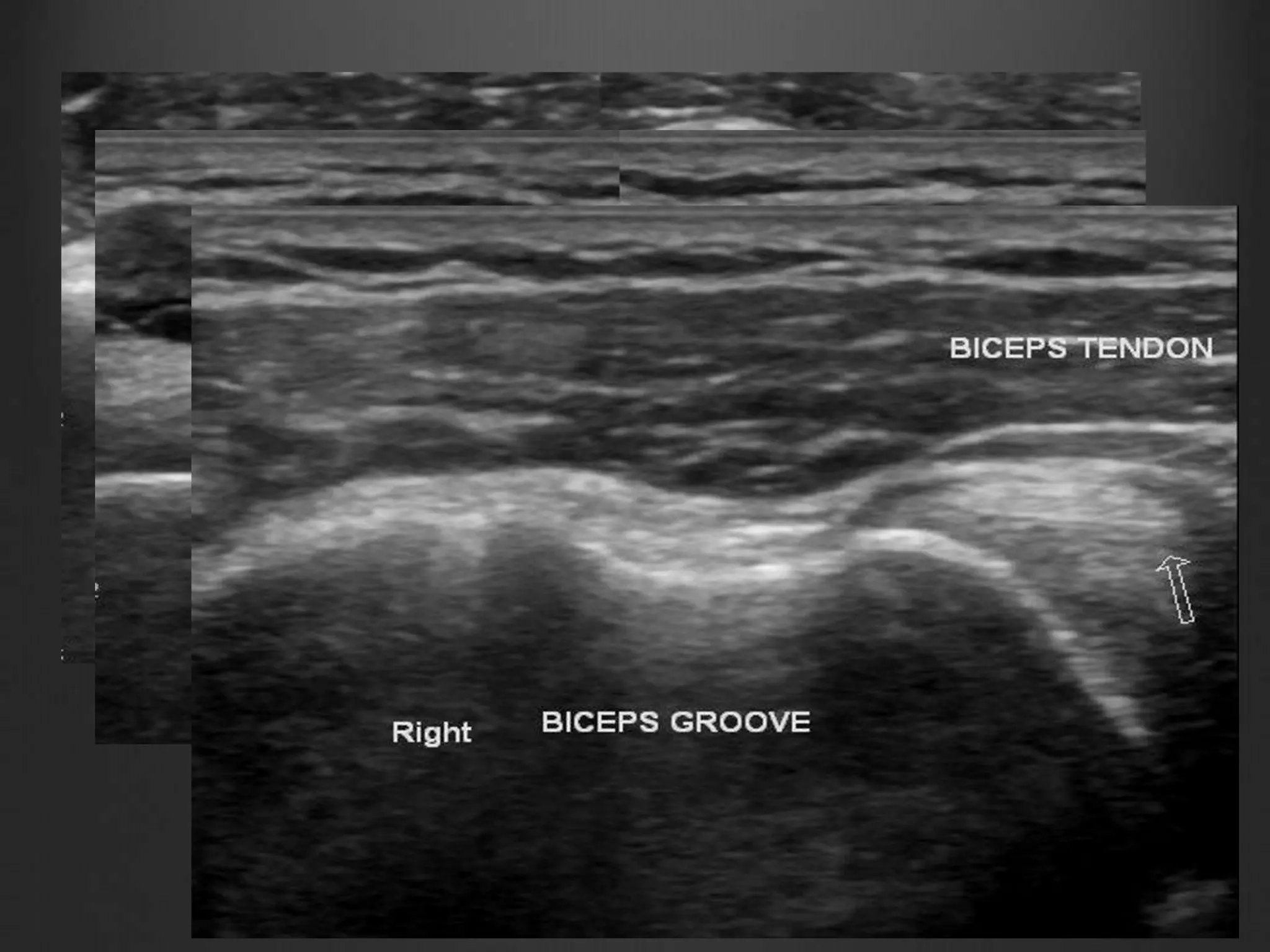 usg shoulder by dr. kanishka.pptx | Death, Injury, or Military Conflict ...