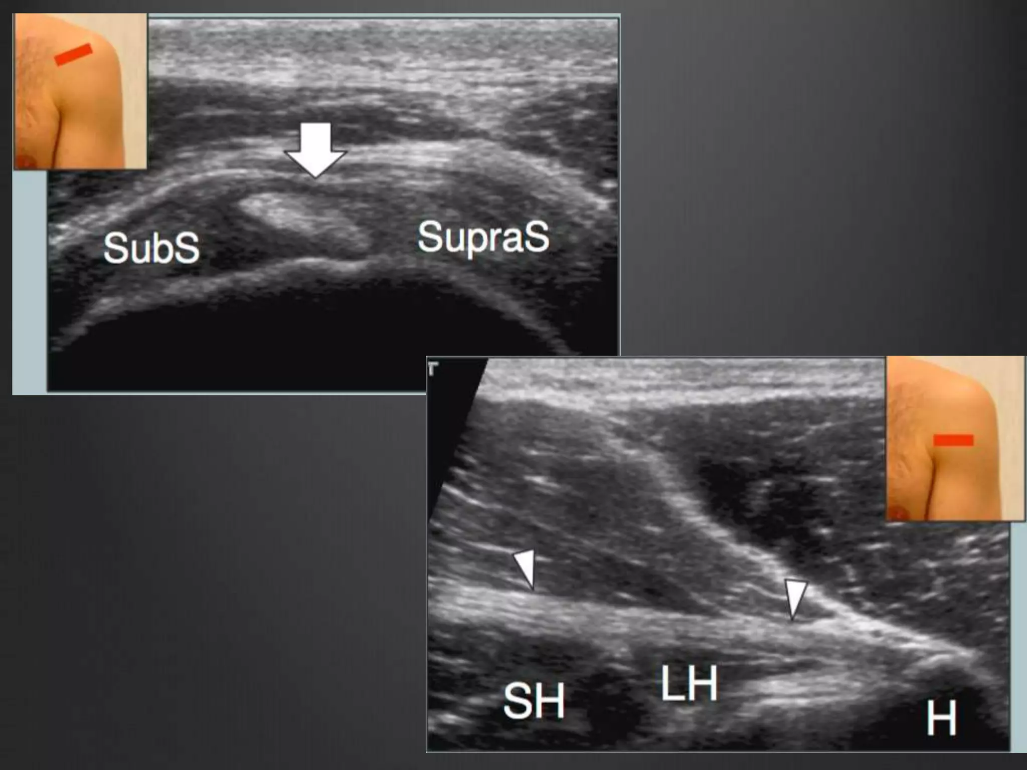 usg shoulder by dr. kanishka.pptx | Death, Injury, or Military Conflict ...