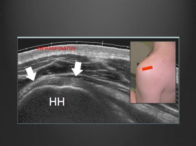 usg shoulder by dr. kanishka.pptx | Death, Injury, or Military Conflict ...
