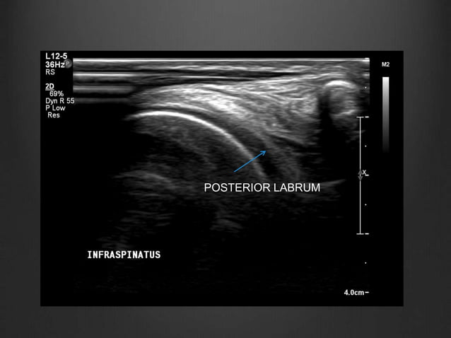 usg shoulder by dr. kanishka.pptx | Death, Injury, or Military Conflict ...