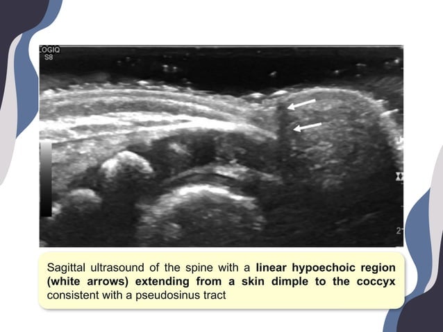 USG Neonatal Spine and Anatomy Variants.pptx