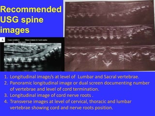 USG Spine.pptx