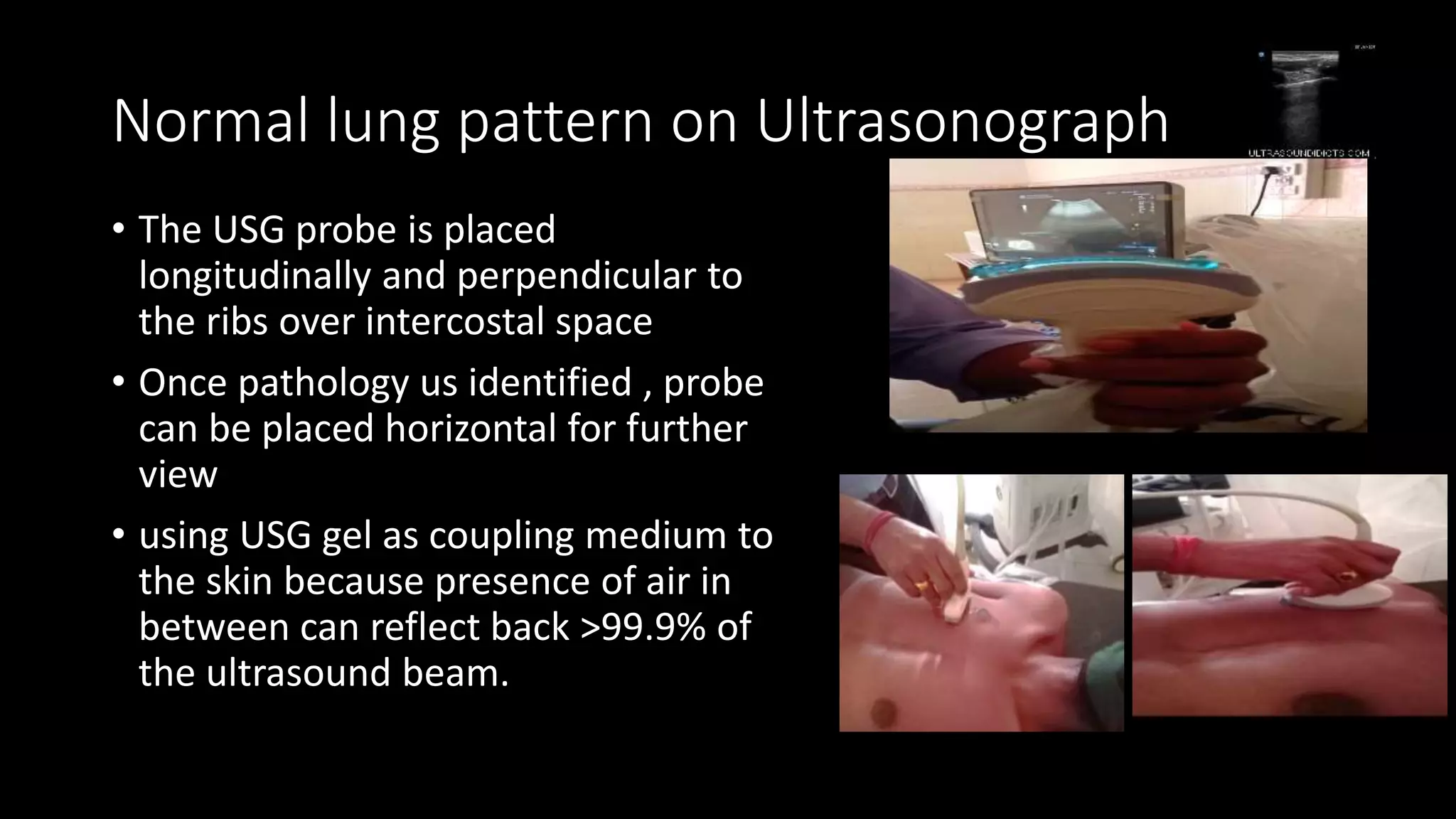 USG THORAX [Autosaved].pptx