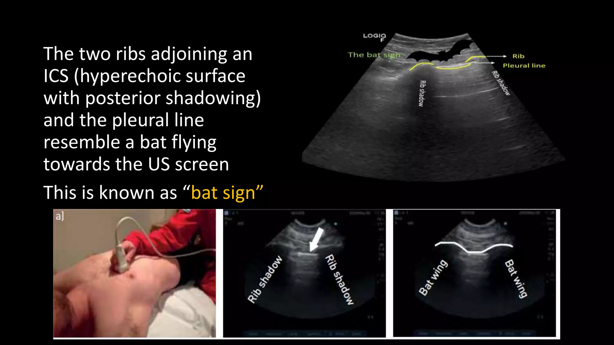 USG THORAX [Autosaved].pptx